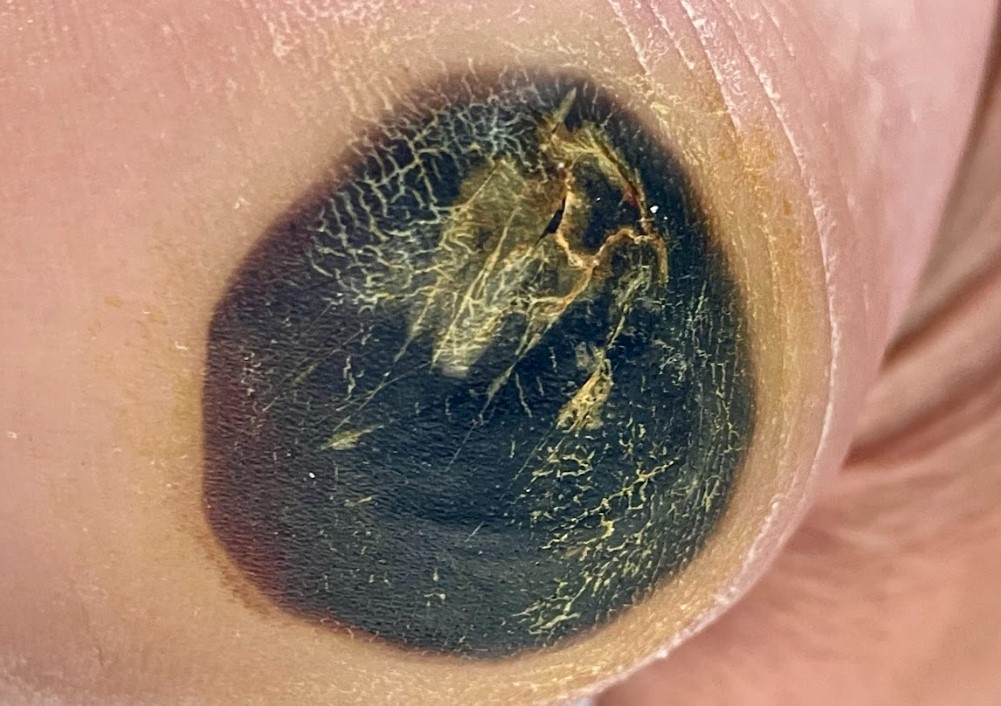 Infermeravirtual.com - Heridas y quemaduras, Problemas de salud